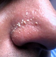 How to Get Rid of Sebaceous Filaments, Squeeze, Minimize Naturally on Nose – Treat, Cure Fast