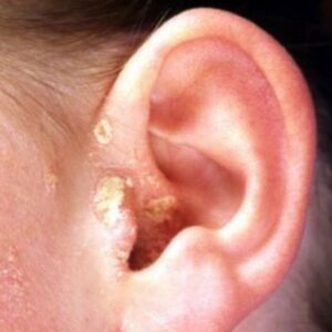 Scab in Ear that Won’t Go Away, in Ear Canal, Lobe and Behind Ears ...