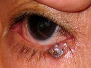 Ingrown Eyelash Hair Causes, Symptoms, Treatment for Trichiasis on ...