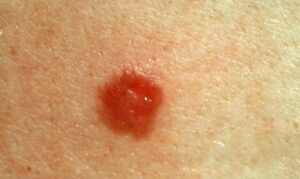 How to Get Rid of Red Moles on Scalp Skin, Body, Breast – Treat, Cure Fast