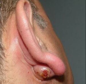 Cyst Behind Ear Lobe Pictures, Treatment – Treat, Cure Fast