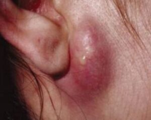 Cyst Behind Ear Lobe Pictures, Treatment – Treat, Cure Fast